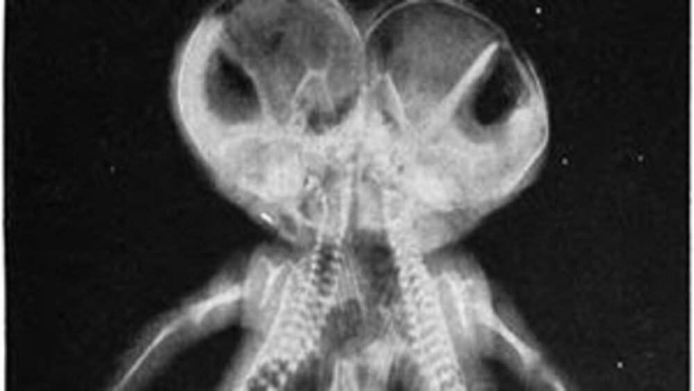 The Fascinating History of Conjoined Twins: From 945 AD to the Siamese ...